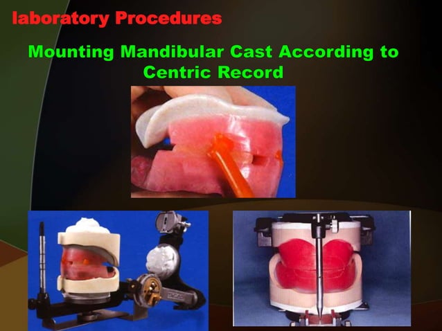 Clinical Steps for Complete Denture Construction 4- Steps of recording ...