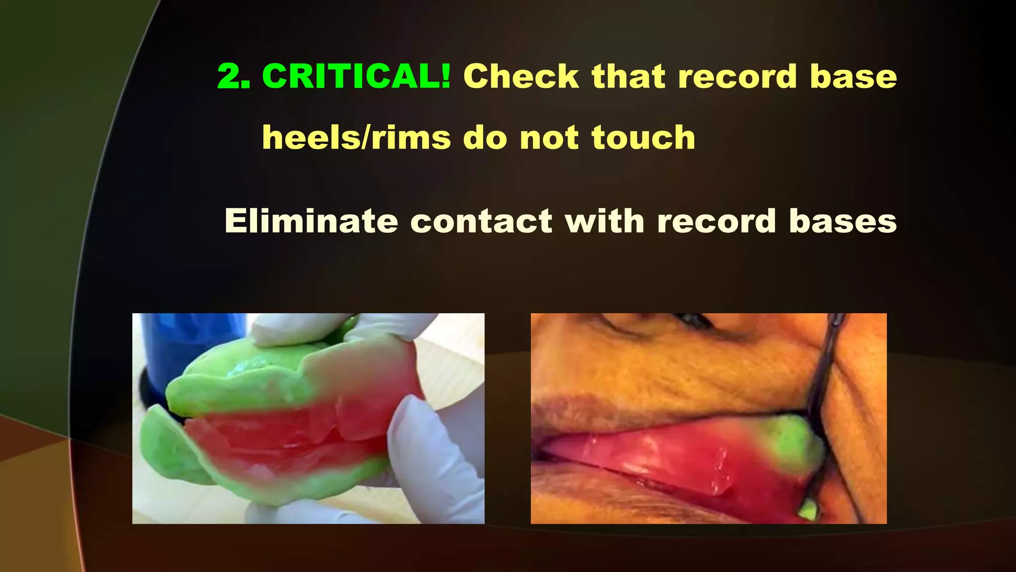 Complete Denture 4- Maxillo-mandibular Relation Records d- Centric ...