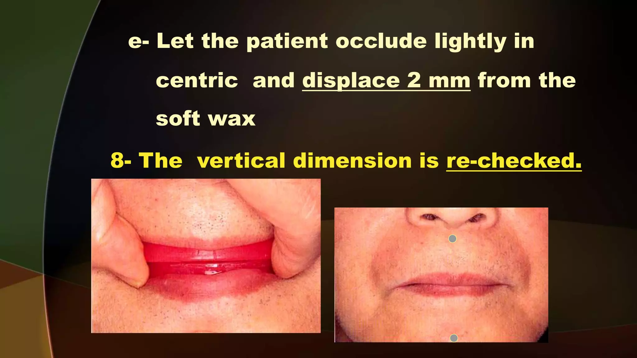 Complete Denture 4- Maxillo-mandibular Relation Records d- Centric ...