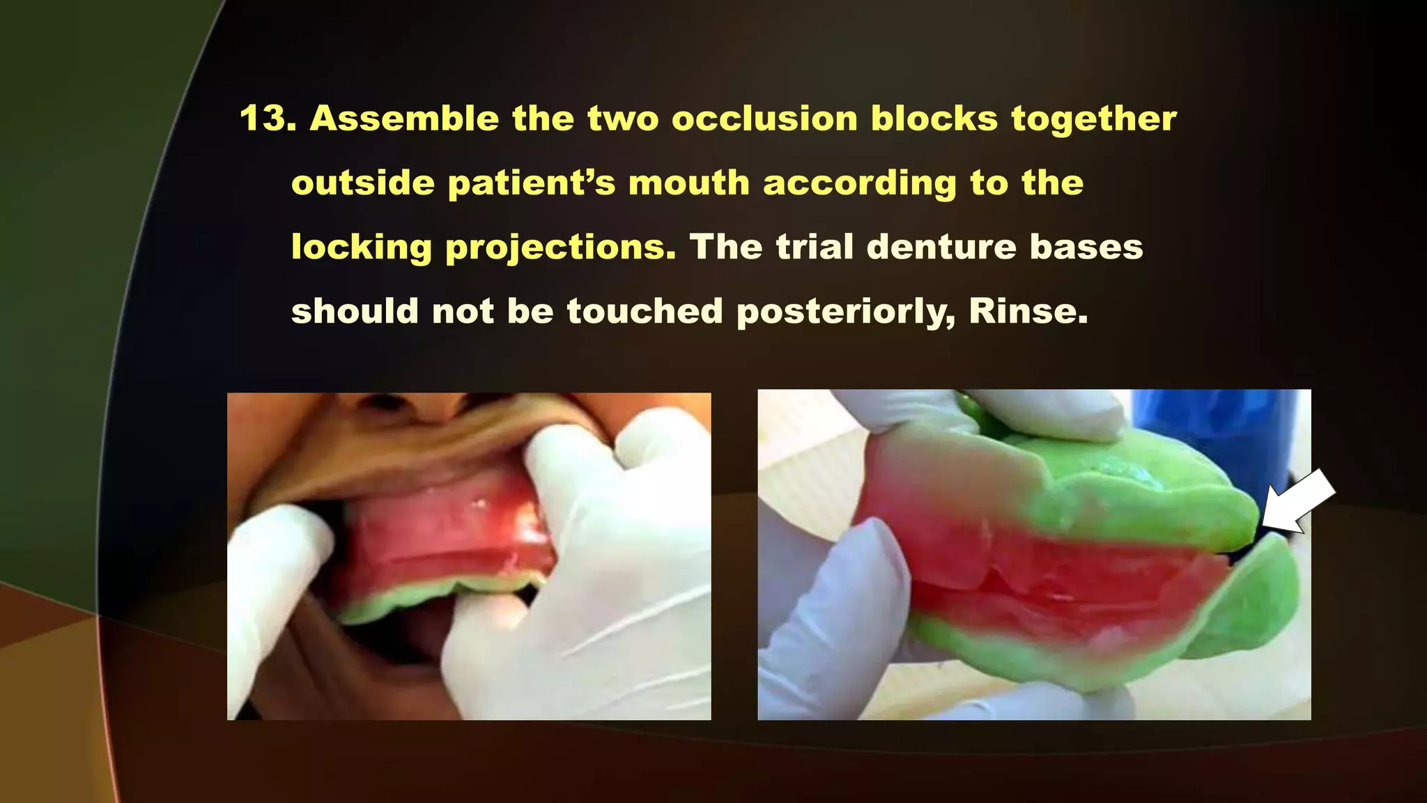 Complete Denture 4- Maxillo-mandibular Relation Records d- Centric ...