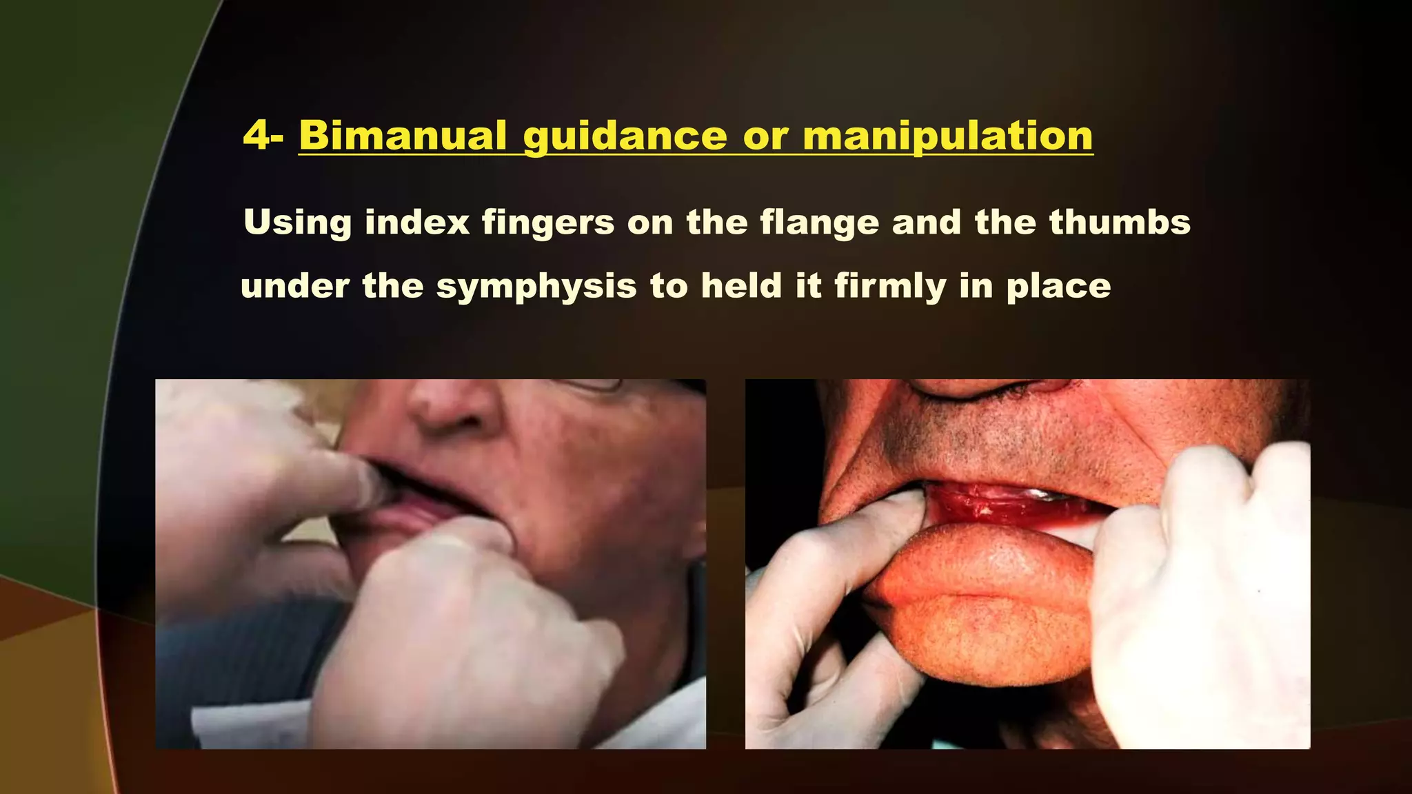 Complete Denture 4- Maxillo-mandibular Relation Records d- Centric ...