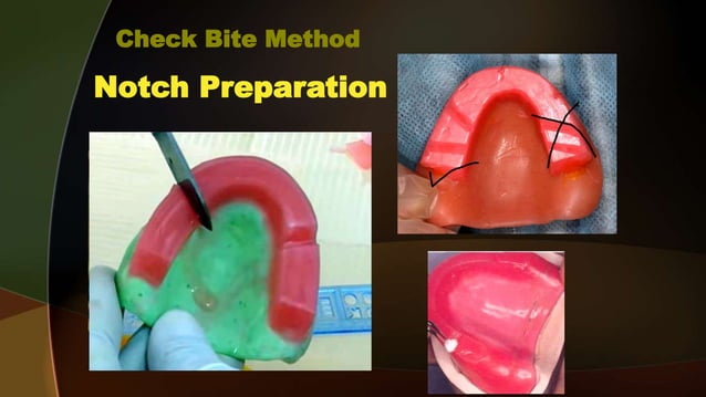 Complete Denture 4- Maxillo-mandibular Relation Records d- Centric ...