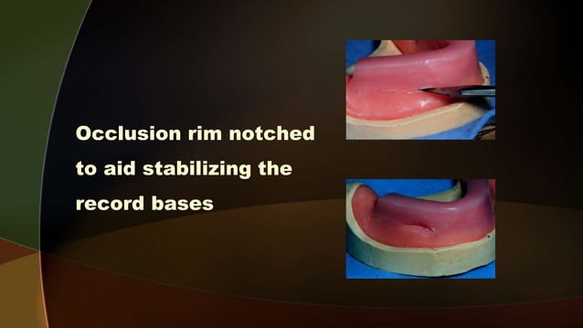 Complete Denture 4- Maxillo-mandibular Relation Records d- Centric ...