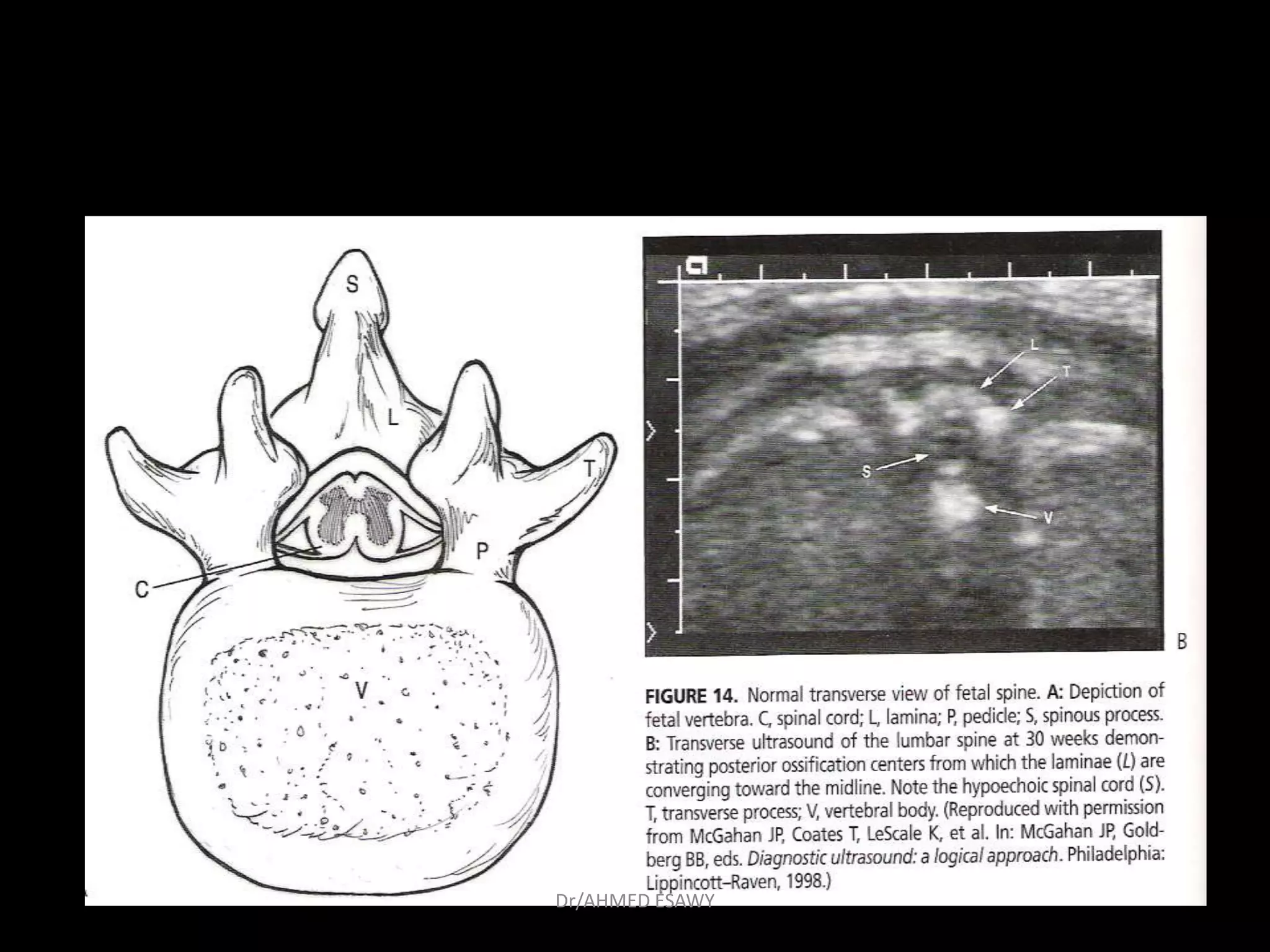 4-fetal spine Dr Ahmed Esawy | PDF