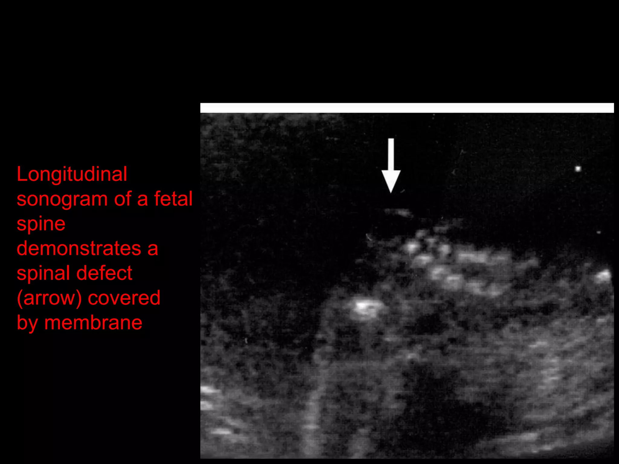 4-fetal spine Dr Ahmed Esawy | PDF