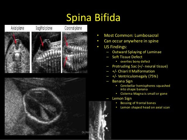 Banana Sign Spina Bifida Association Of Lemon Sign Of Fetal Skull With