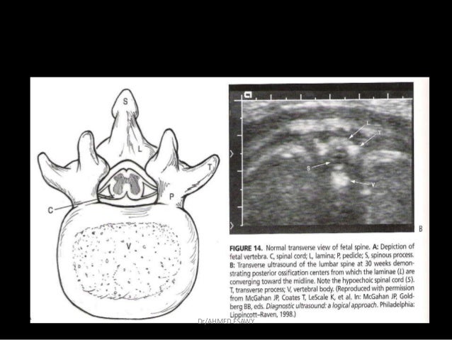 4-fetal spine Dr Ahmed Esawy