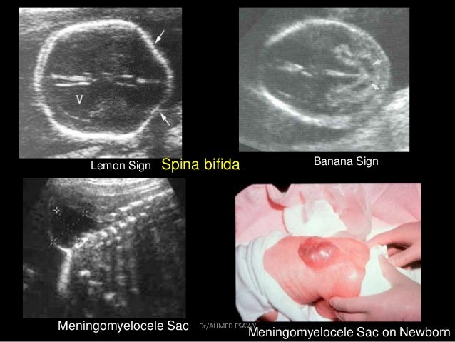 4-fetal spine Dr Ahmed Esawy