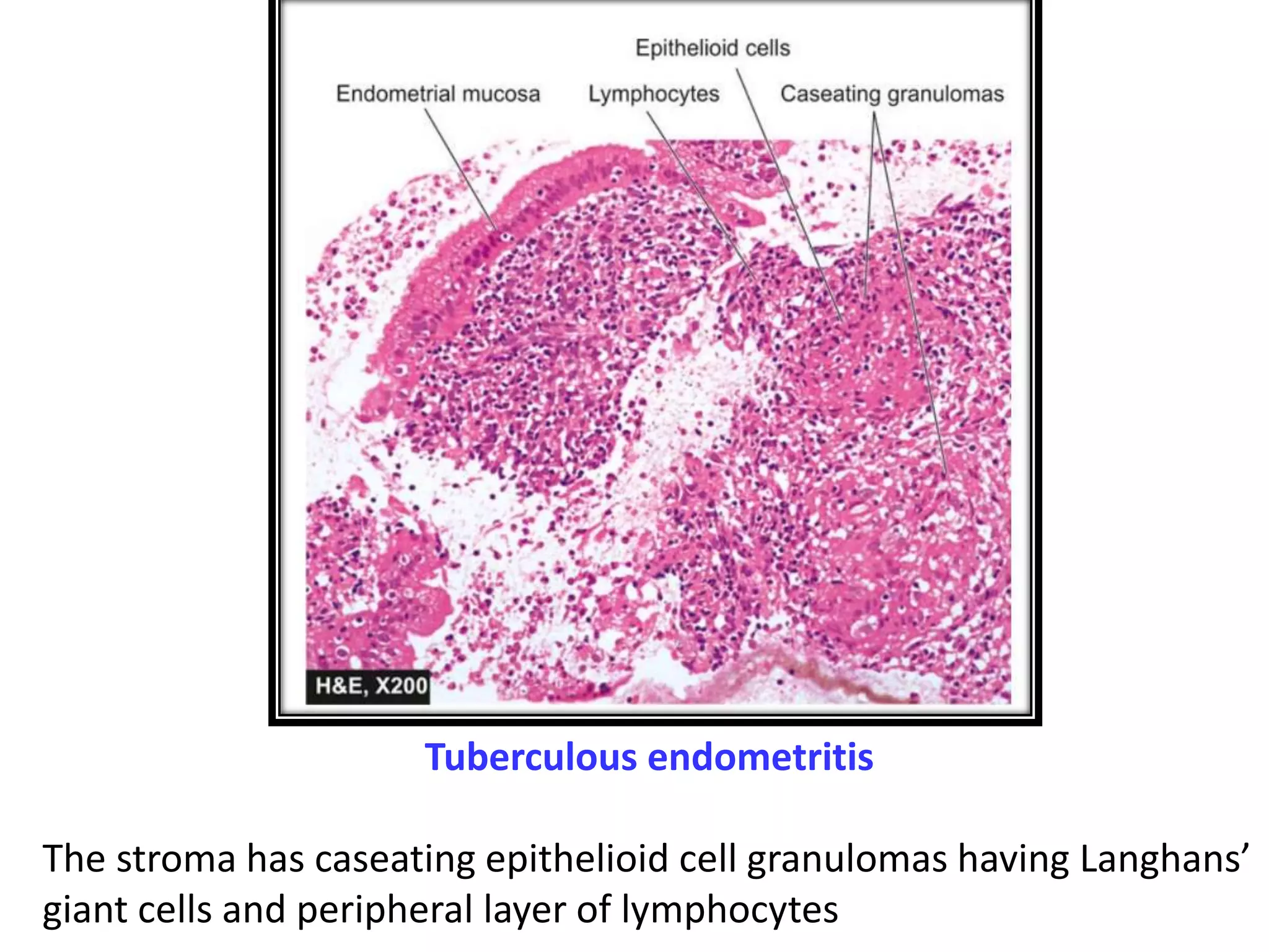 FEMALE GENITAL SYSTEM: INVASIVE CERVICAL CANCER & ENDOMETRIAL CARCINOMA ...