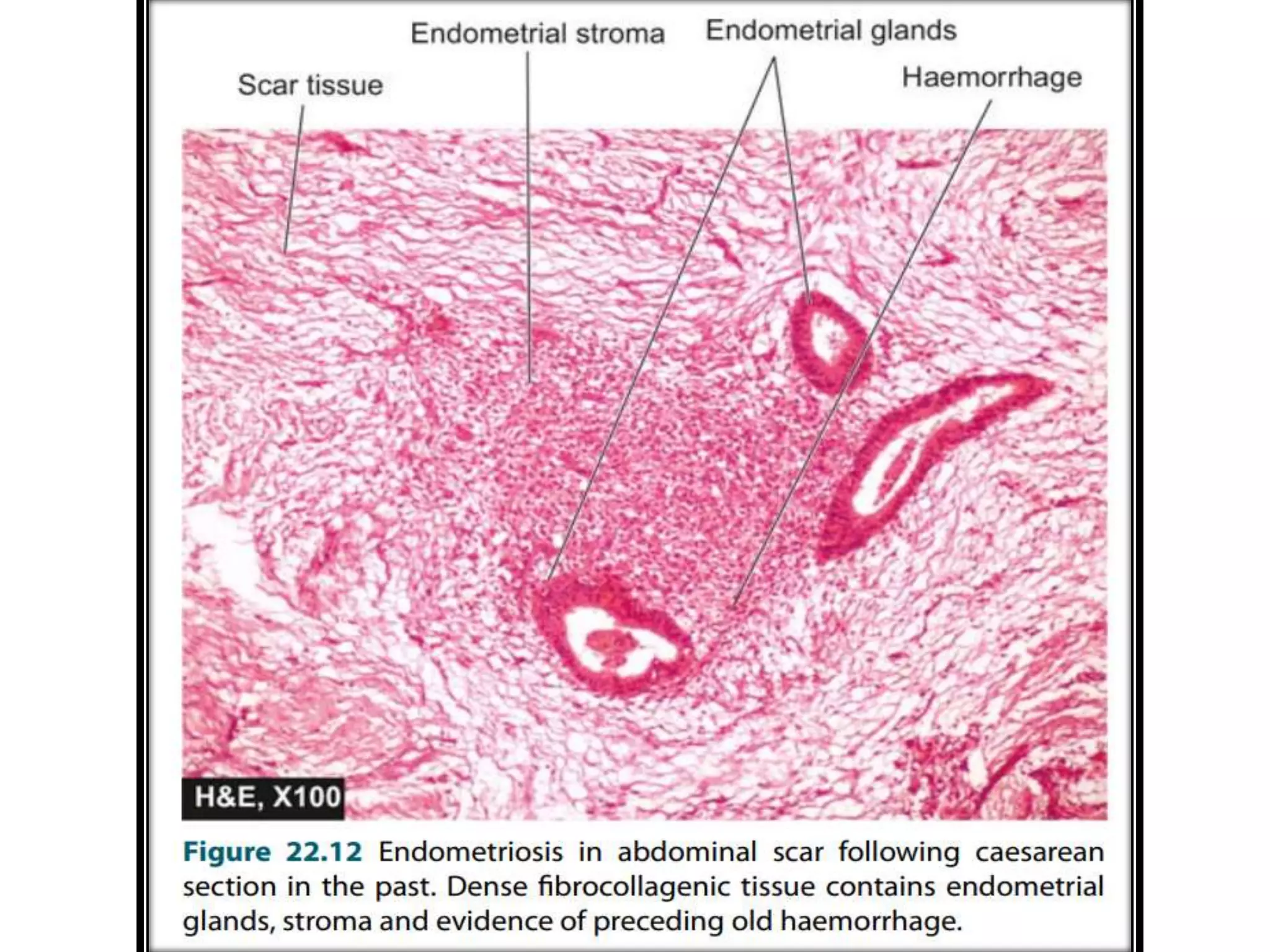FEMALE GENITAL SYSTEM: INVASIVE CERVICAL CANCER & ENDOMETRIAL CARCINOMA ...