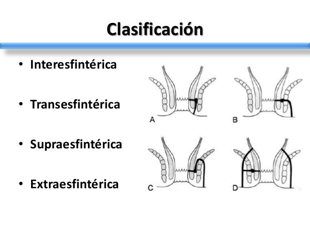 4. fistulas arp