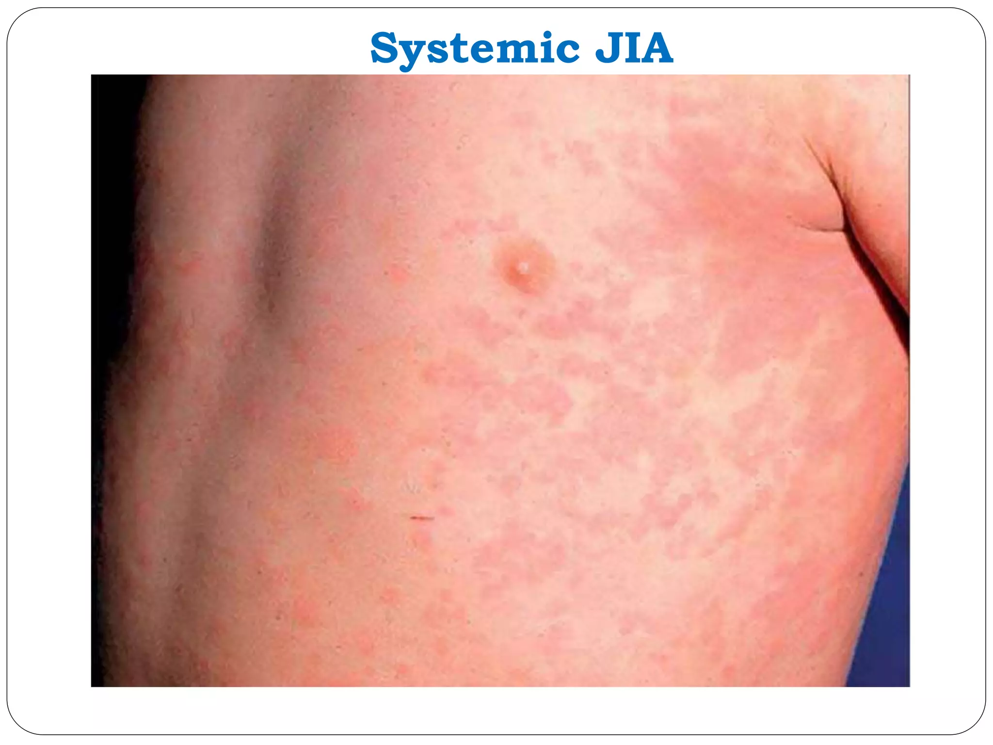 Juvenile idiopathic arthritis (JIA) | PPTX