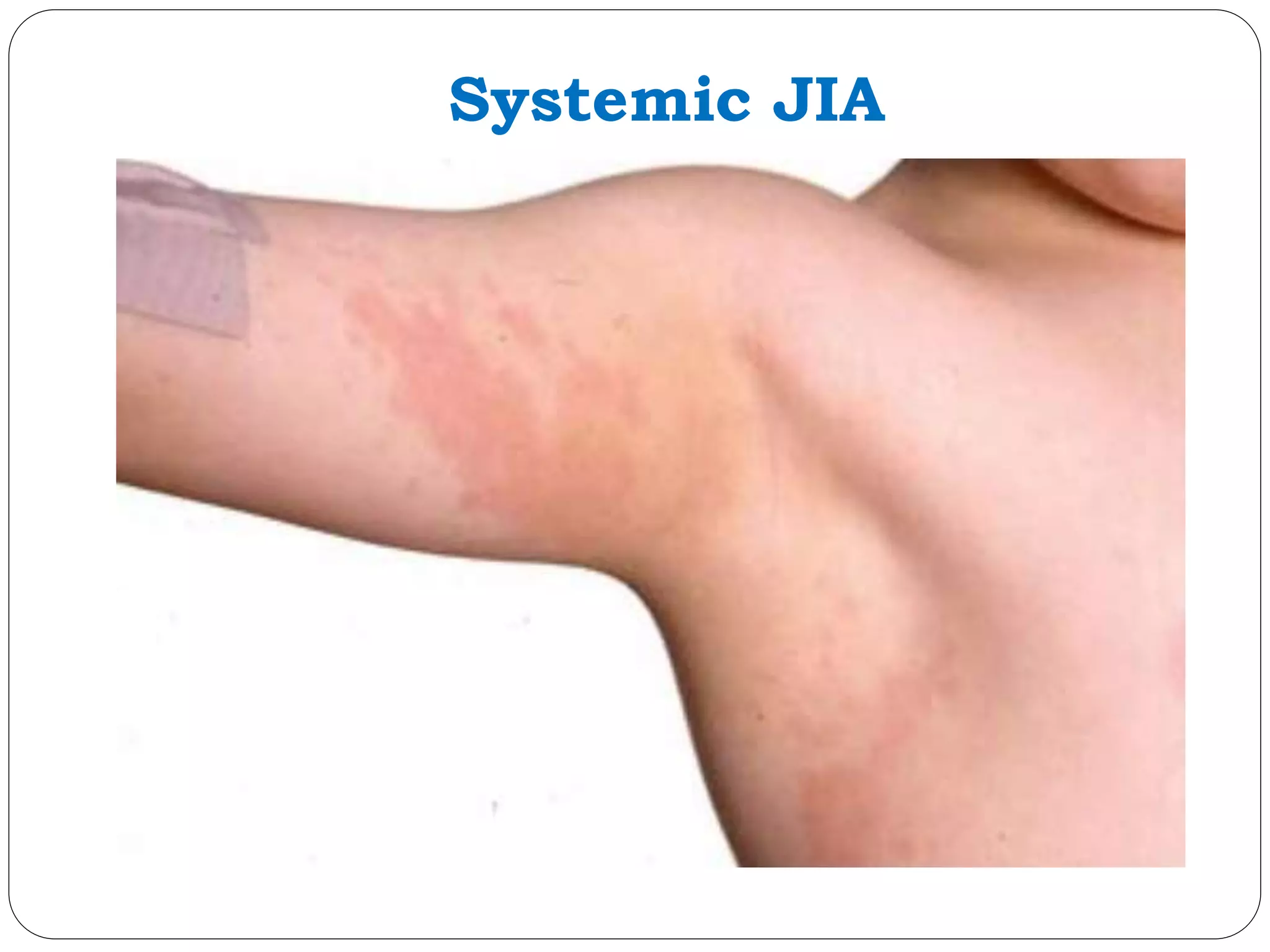 Juvenile idiopathic arthritis (JIA) | PPTX