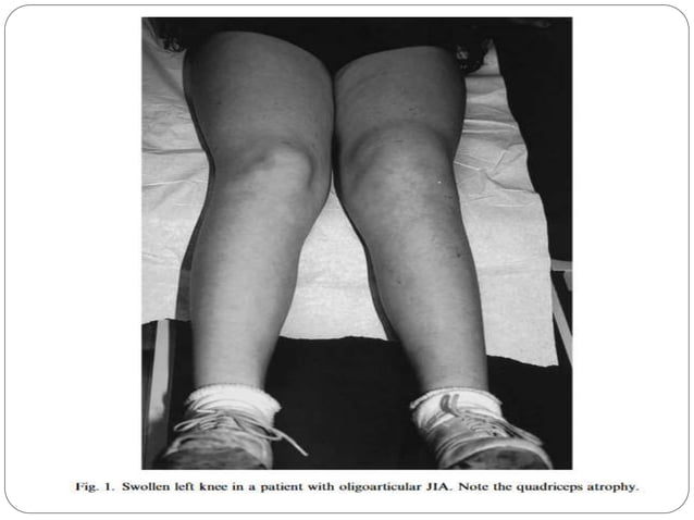 Juvenile idiopathic arthritis (JIA) | PPTX