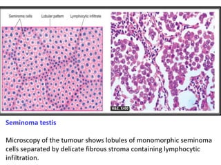 MALE GENITAL TRACT – TESTICULAR TUMORS | PPTX