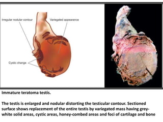 MALE GENITAL TRACT – TESTICULAR TUMORS | PPTX