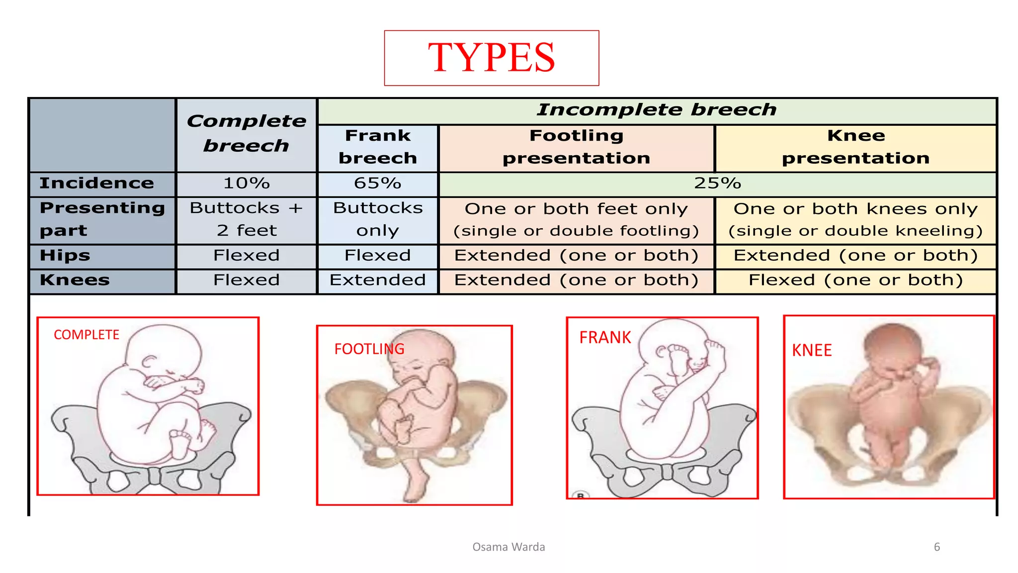 4 malpresentations.warda( 4)-BREECH | PDF