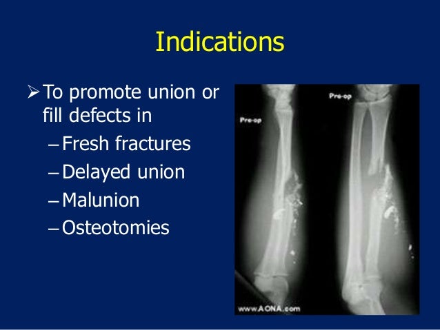 Bone Grafting In Orthopedic