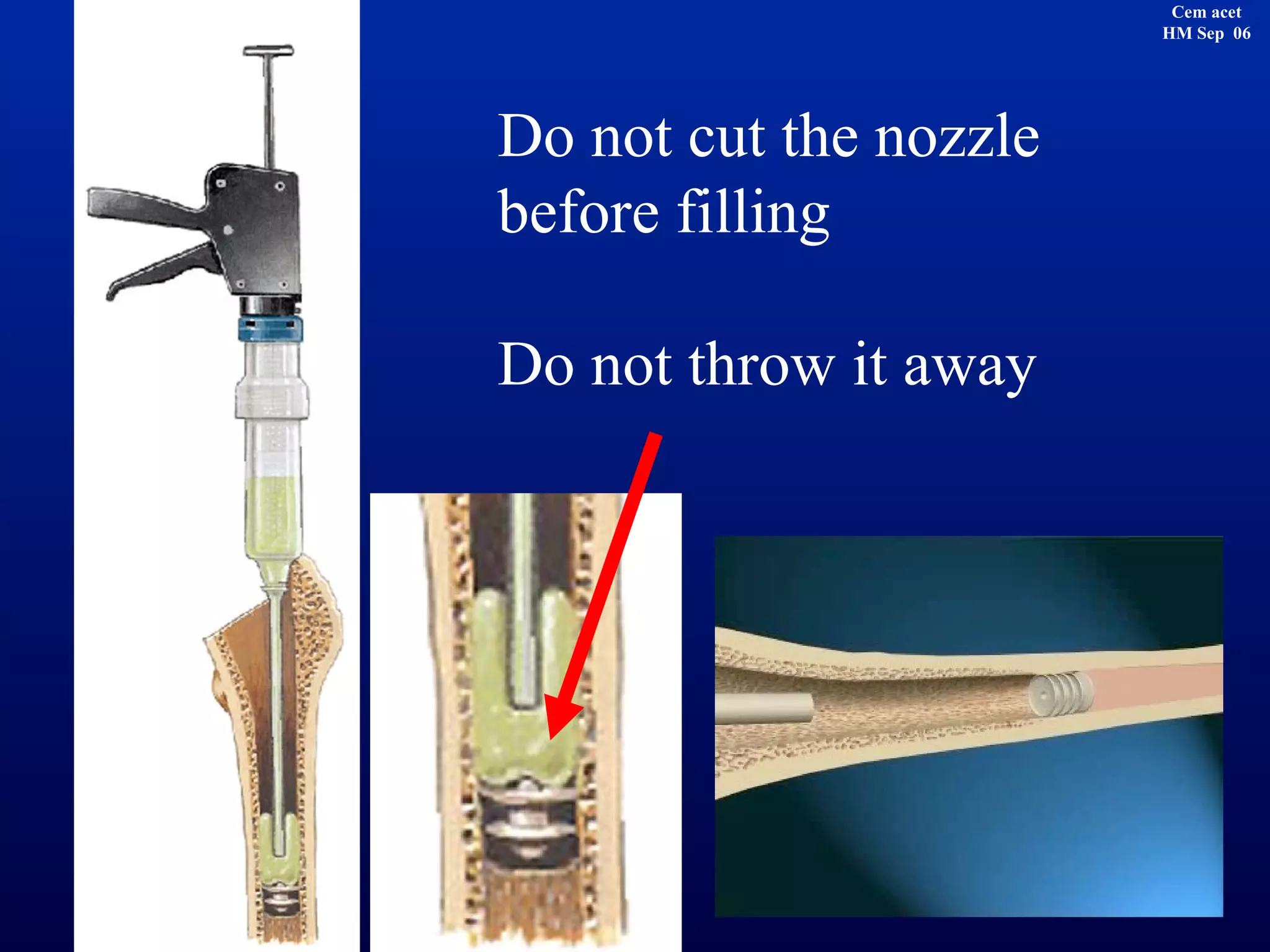 Modern Cementing Technique: Femur | PPT