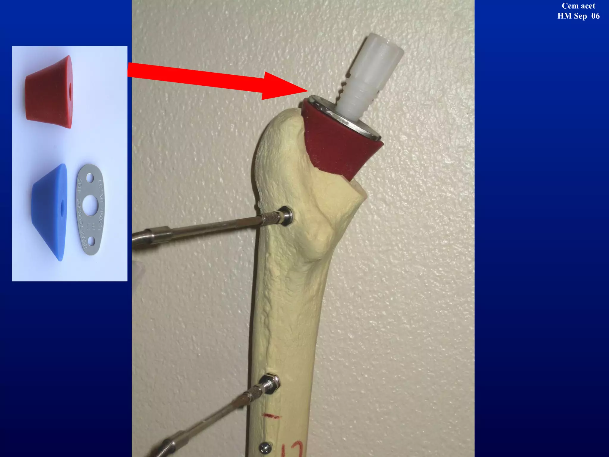 Modern Cementing Technique: Femur | PPT