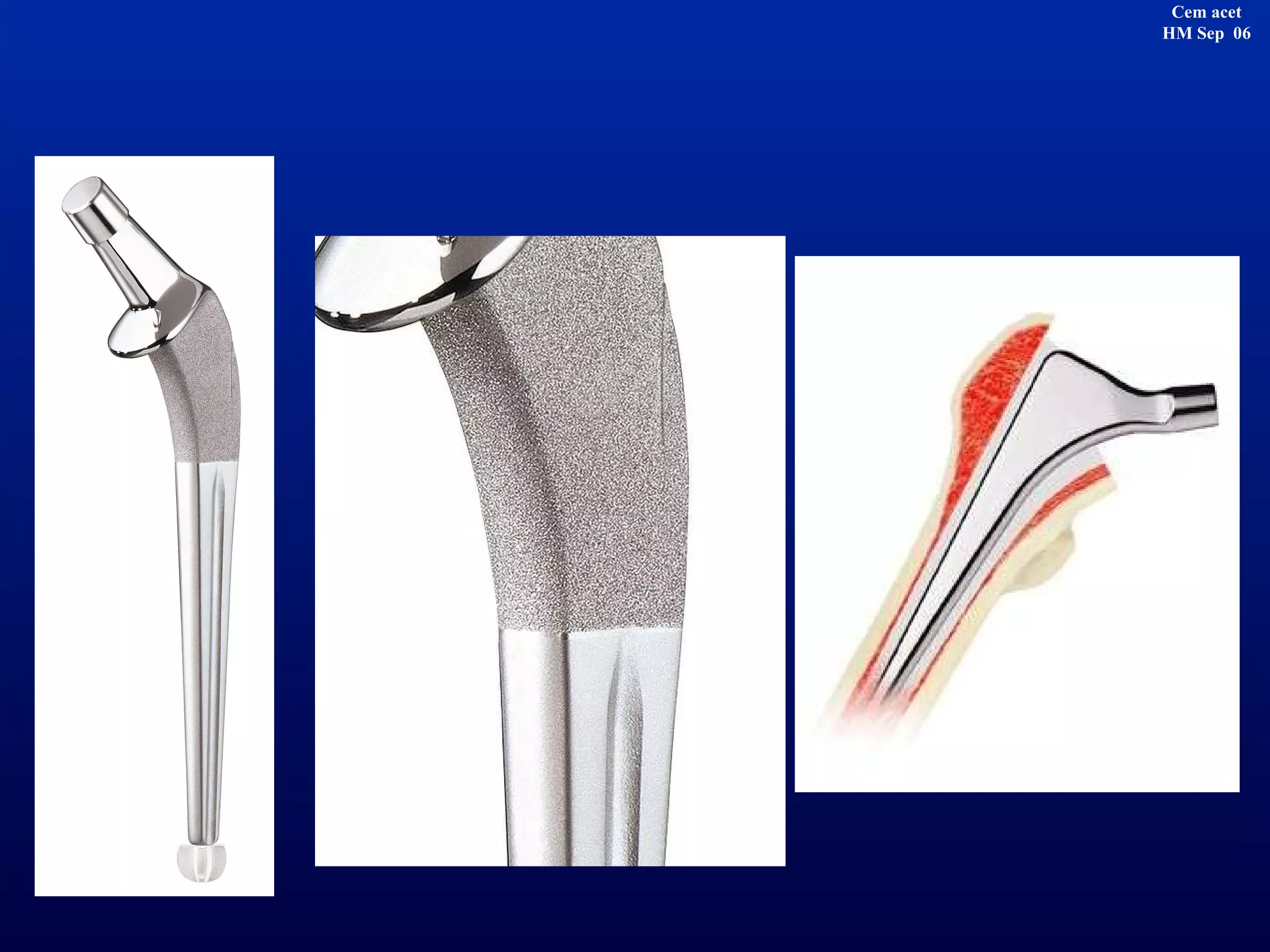 Modern Cementing Technique: Femur | PPT