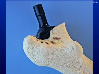 Modern Cementing Technique: Femur | PPT