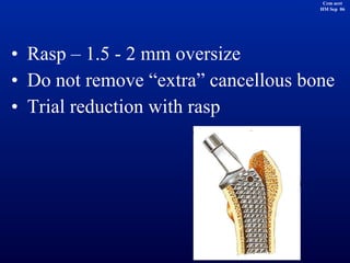 Modern Cementing Technique: Femur | PPT