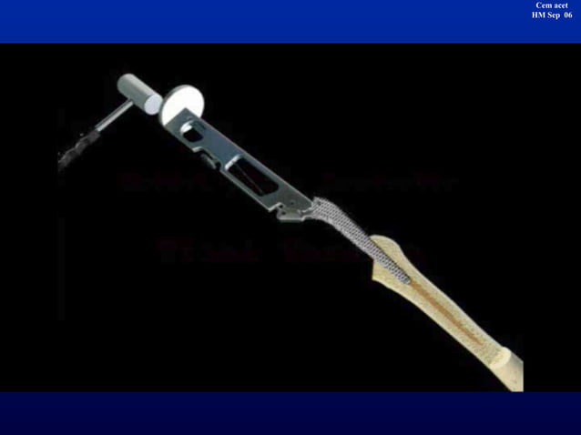 Modern Cementing Technique: Femur | PPT