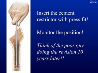 Modern Cementing Technique: Femur | PPT