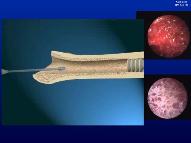 Modern Cementing Technique: Femur | PPT