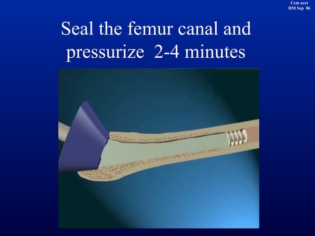 Modern Cementing Technique: Femur | PPT