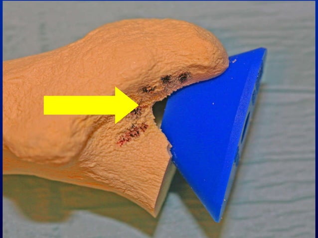 Modern Cementing Technique: Femur | PPT