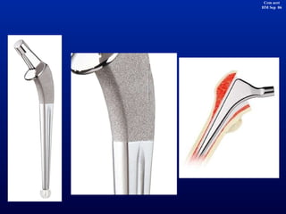 Modern Cementing Technique: Femur | PPT