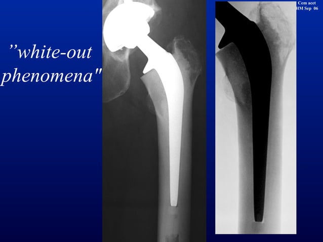 Modern Cementing Technique: Femur | PPT