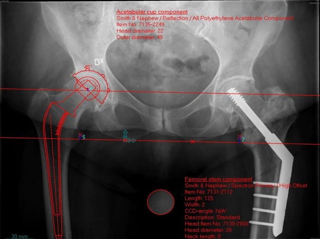Modern Cementing Technique: Femur | PPT
