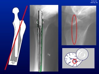 Modern Cementing Technique: Femur | PPT