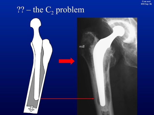 Modern Cementing Technique: Femur | PPT