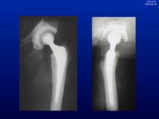 Modern Cementing Technique: Femur | PPT