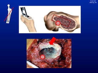 Modern Cementing Technique: Femur | PPT