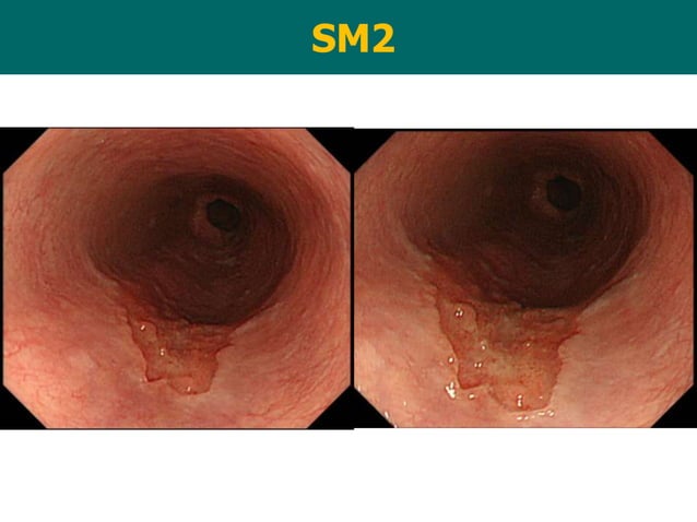 Endoscopy in Gastrointestinal Oncology - Slide 4 - I. Oda - Esophageal ...