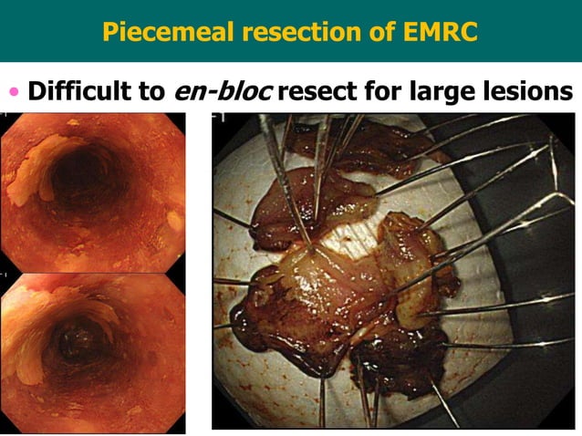 Endoscopy in Gastrointestinal Oncology - Slide 4 - I. Oda - Esophageal ...