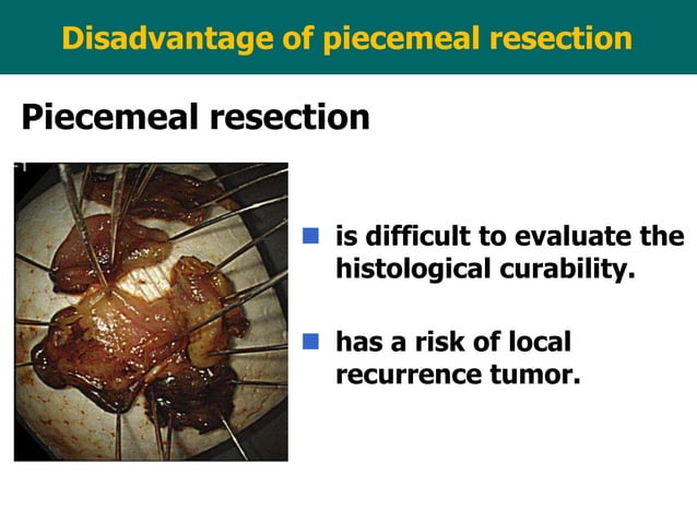 Endoscopy in Gastrointestinal Oncology - Slide 4 - I. Oda - Esophageal ...