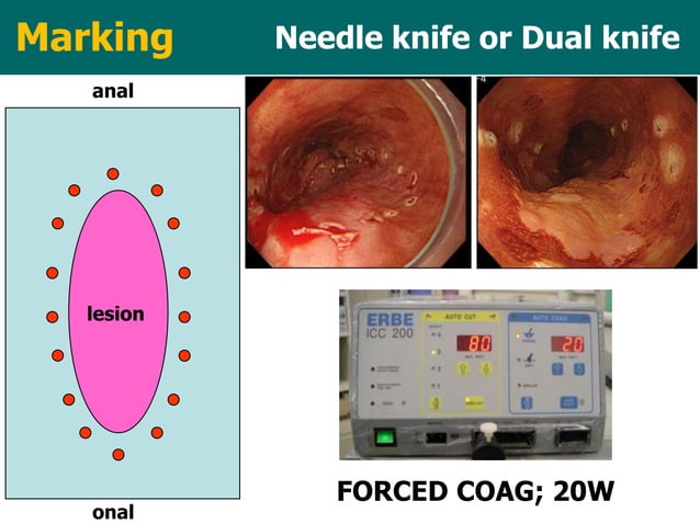 Endoscopy in Gastrointestinal Oncology - Slide 4 - I. Oda - Esophageal ...