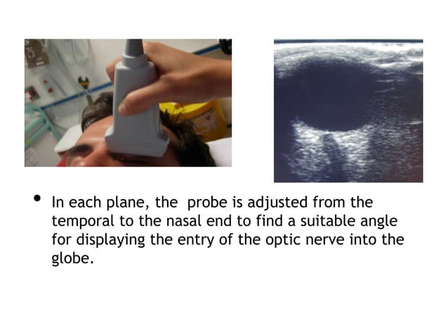 Ocular Ultrasound for raised ICP | PPTX