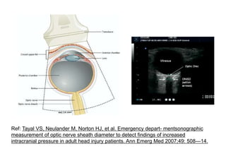 Ocular Ultrasound for raised ICP | PPTX