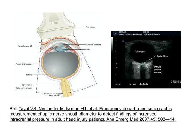 Ocular Ultrasound for raised ICP | PPTX