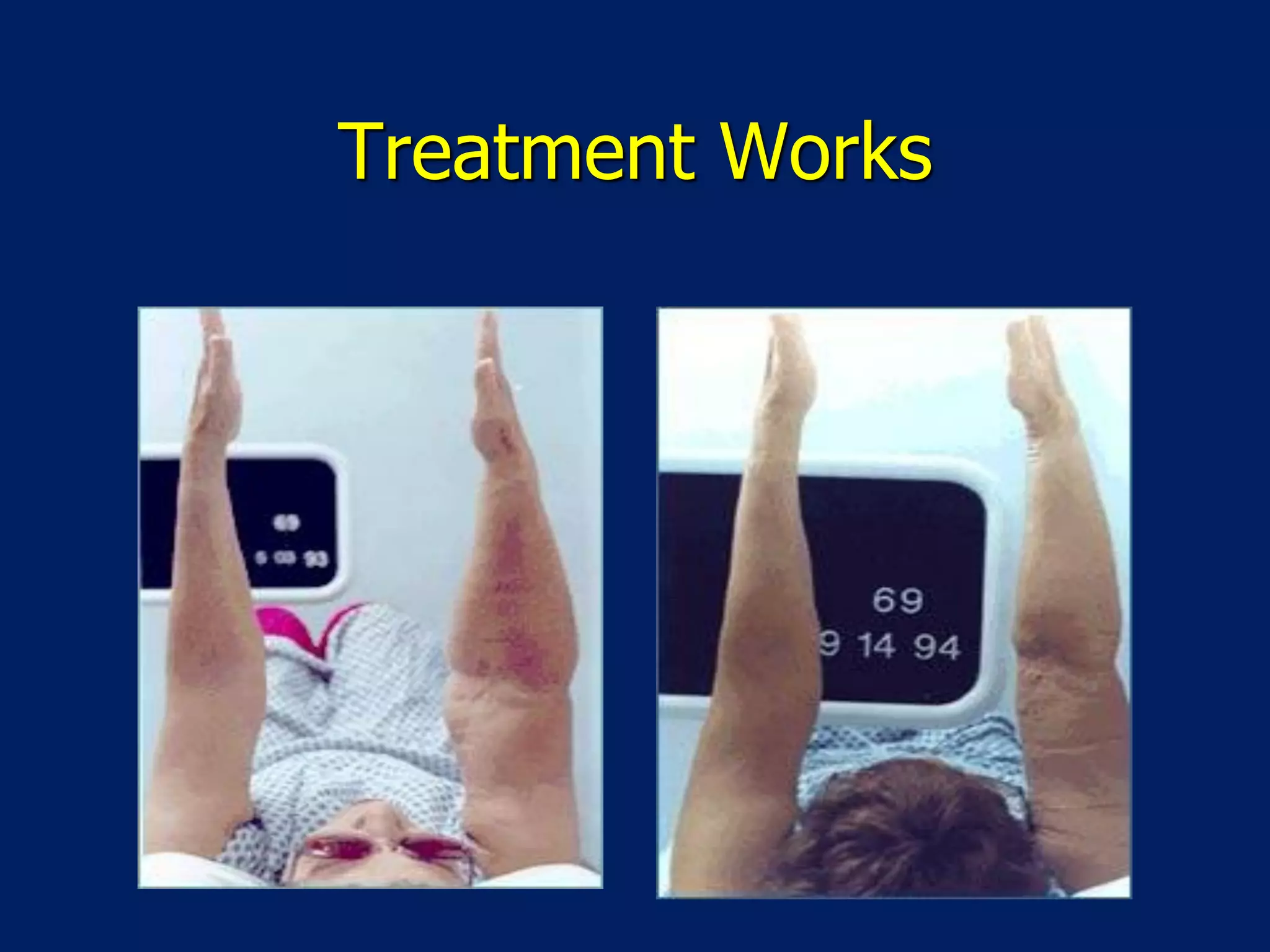 4-patho_lymphedema.pdf