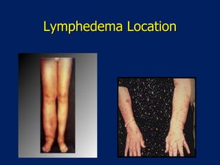 4-patho_lymphedema.pdf