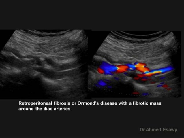 4 peripheral arterial triplex ultrasound vasculitis dr ahmed esawy