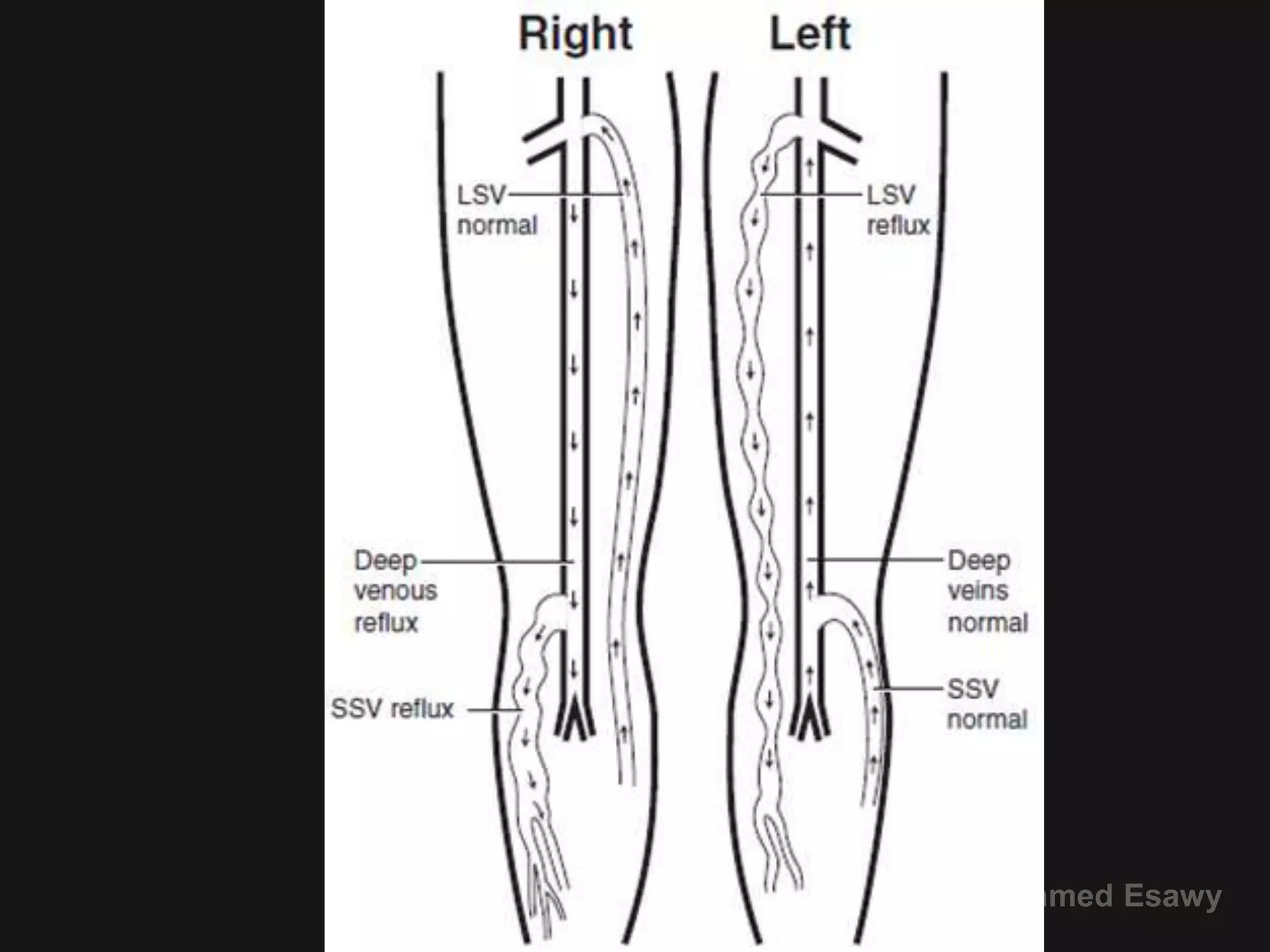 4 peripheral venous duplex pt 4 varices dr ahmed esawy | PPTX